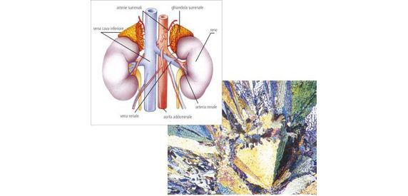 Morbo di addison: definizione e significato medico | Corriere Salute