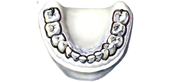 Piorrea: definizione e significato medico | Corriere Salute