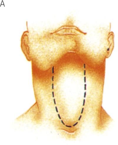 Laringectomia: definizione e significato medico | Corriere Salute