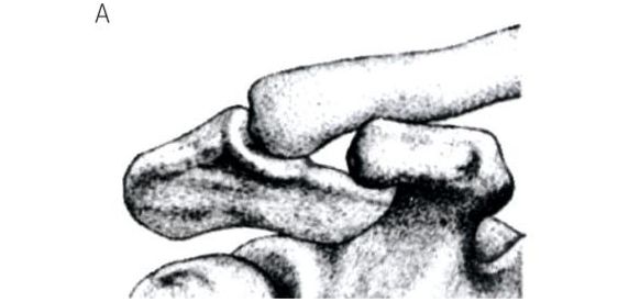 Frattura della clavicola: definizione e significato medico | Corriere ...