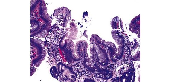 Esofago di barrett: definizione e significato medico | Corriere Salute