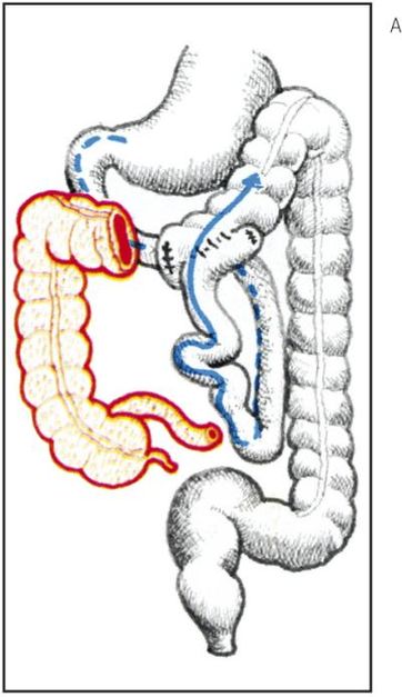 Emicolectomia: definizione e significato medico | Corriere Salute