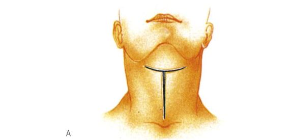 Laringectomia: definizione e significato medico | Corriere Salute