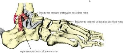 Frattura del piede: definizione e significato medico | Corriere Salute