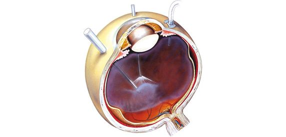 Vitrectomia: definizione e significato medico | Corriere Salute