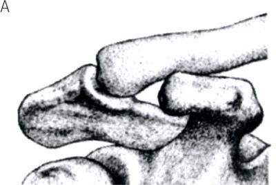 Frattura della clavicola: definizione e significato medico | Corriere ...