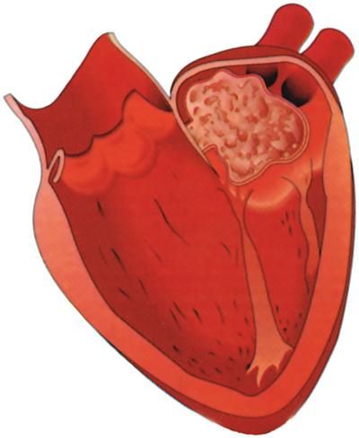 Mixoma: definizione e significato medico | Corriere Salute