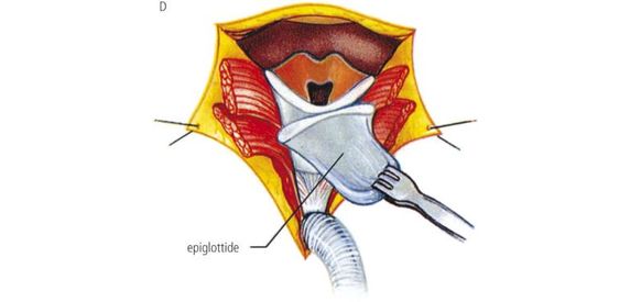 Laringectomia: definizione e significato medico | Corriere Salute