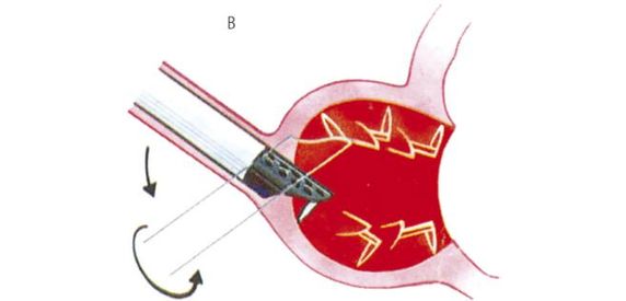Prostatectomia: definizione e ultime news | Corriere Salute
