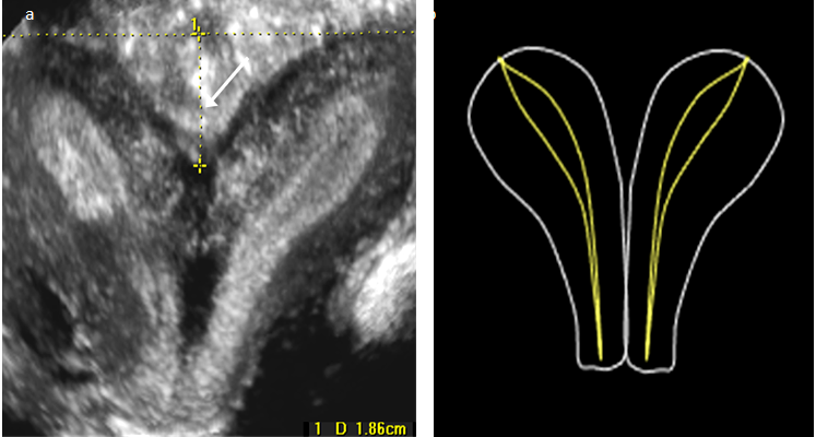 Utero didelfo: definizione e significato medico | Corriere Salute