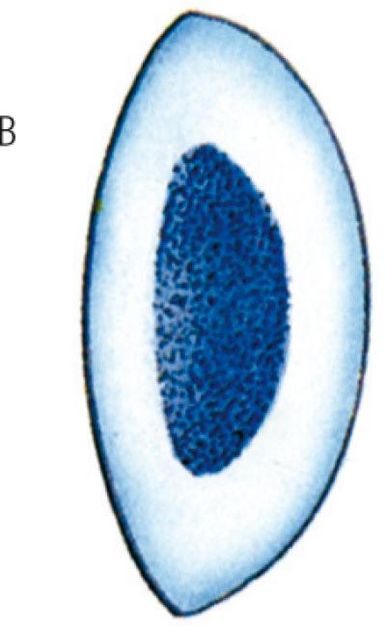 Cataratta: definizione e significato medico | Corriere Salute