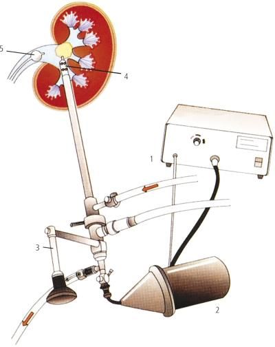 Litotripsia: definizione e significato medico | Corriere Salute