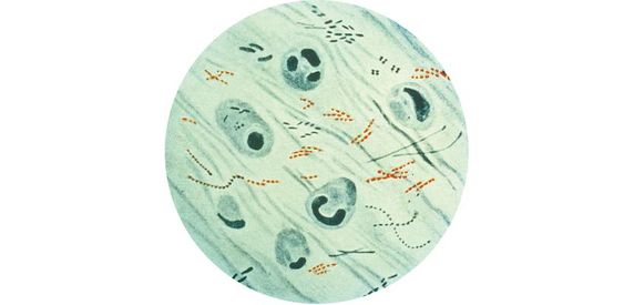 Scrofolosi: definizione e significato medico | Corriere Salute