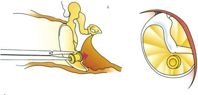 Otorrea: definizione e significato medico | Corriere Salute