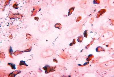 Pinta: definizione e significato medico | Corriere Salute