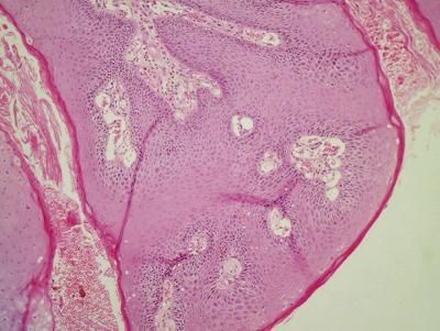 Condiloma: definizione e significato medico | Corriere Salute