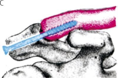 Frattura della clavicola: definizione e significato medico | Corriere ...