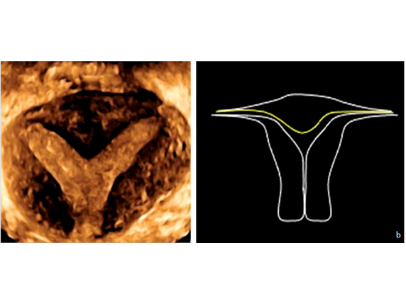 Utero setto: definizione e significato medico | Corriere Salute