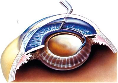 Cataratta: definizione e significato medico | Corriere Salute