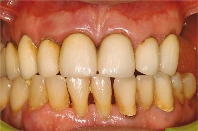 Parodonto: definizione e significato medico | Corriere Salute