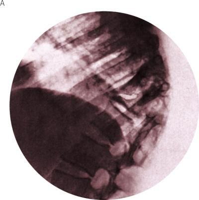 Gibbo: definizione e significato medico | Corriere Salute