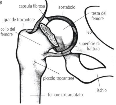 Frattura del collo del femore: definizione e significato medico ...