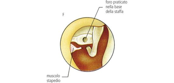 Stapedectomia: definizione e significato medico | Corriere Salute
