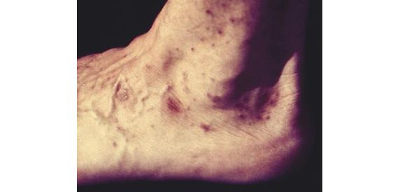 Griseofulvina: definizione e significato medico | Corriere Salute