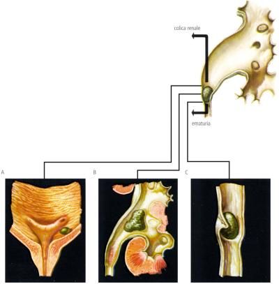 Calcolosi: definizione e significato medico | Corriere Salute