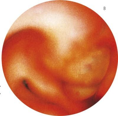 Ozena: definizione e significato medico | Corriere Salute