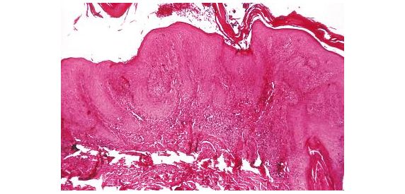 Pinta: definizione e significato medico | Corriere Salute