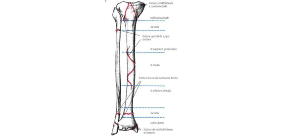 Frattura della gamba: definizione e significato medico | Corriere Salute