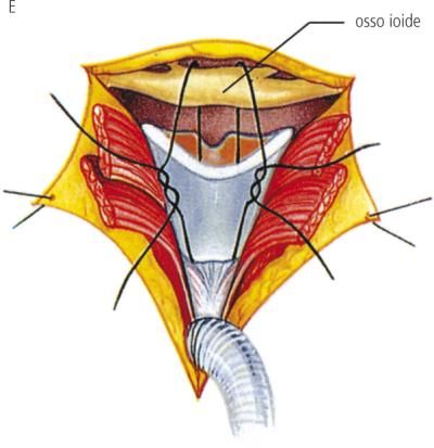 Laringectomia: definizione e significato medico | Corriere Salute