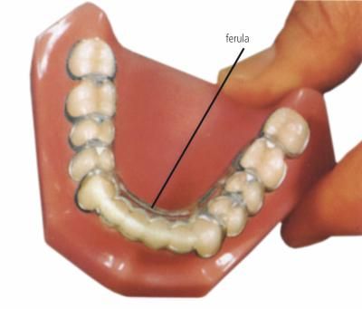 Ferula: definizione e significato medico | Corriere Salute