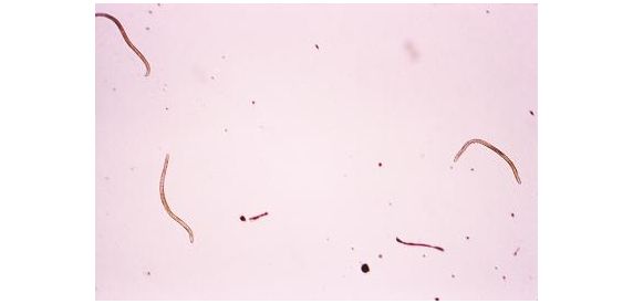 Oncocercosi: definizione e significato medico | Corriere Salute