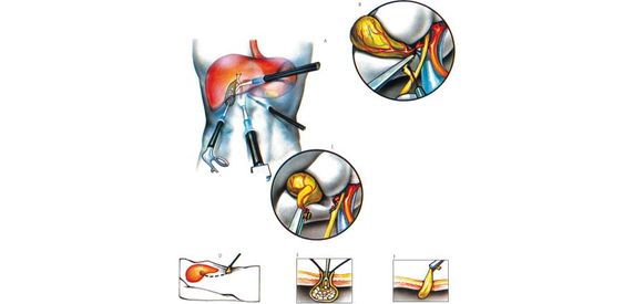 Colecistectomia: definizione e significato medico | Corriere Salute