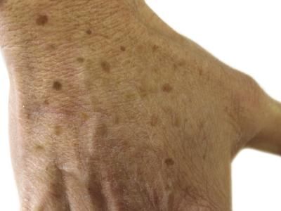 Macchia: definizione e significato medico | Corriere Salute