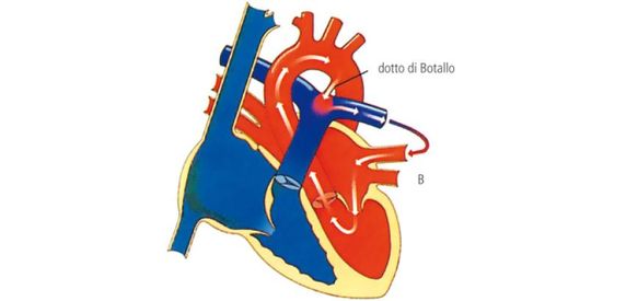 Dotto di botallo: definizione e significato medico | Corriere Salute