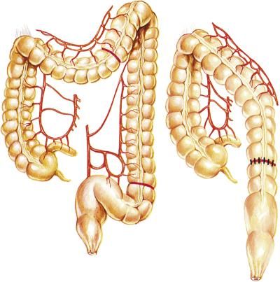 Emicolectomia: definizione e significato medico | Corriere Salute