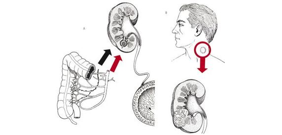 Nefrite: definizione e ultime news | Corriere Salute