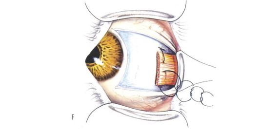 Strabismo: definizione e significato medico | Corriere Salute