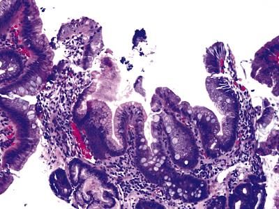 Esofago di barrett: definizione e significato medico | Corriere Salute