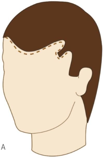 Calvizie: definizione e significato medico | Corriere Salute