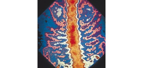 Discopatia: definizione e significato medico | Corriere Salute