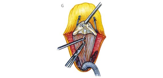 Laringectomia: definizione e significato medico | Corriere Salute