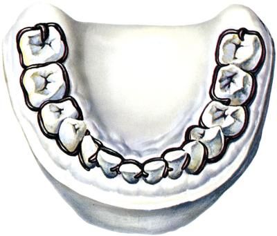 Ferula: definizione e significato medico | Corriere Salute